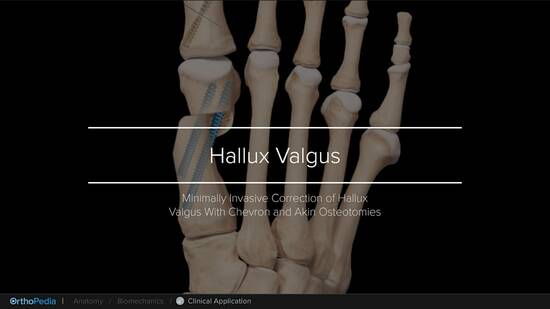 Hallux Valgus: Minimally Invasive Surgery Correction With Distal ...