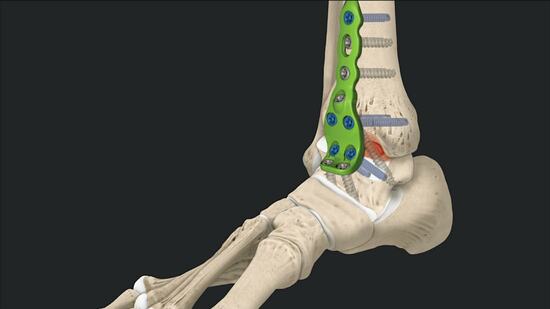Hindfoot and Ankle Arthritis: Ankle Arthrodesis With the Anterior Ankle ...