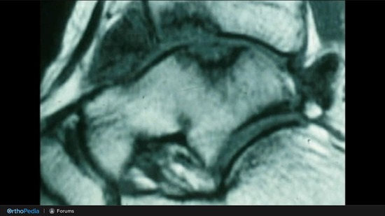 InternalBrace™ Ligament Augmentation Procedure: Part 4—Traditional ...