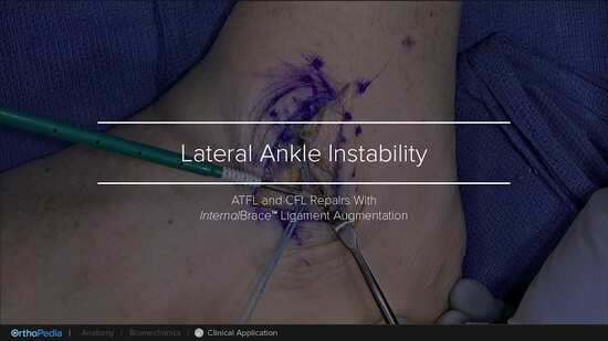 Lateral Ankle Ligament Injuries: Combined ATFL and CFL Repairs With the ...