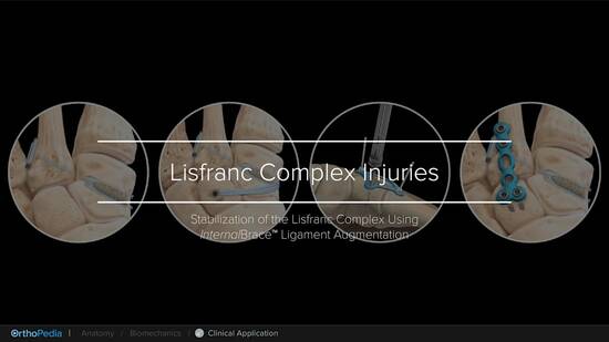 Lisfranc Complex Injuries: Stabilization of the Lisfranc Complex Using ...
