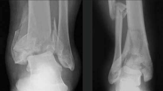 Pilon Fractures: General Surgical Considerations : OrthoPedia