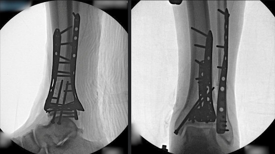 Pilon Fractures: Open Reduction Internal Fixation With Anterolateral ...