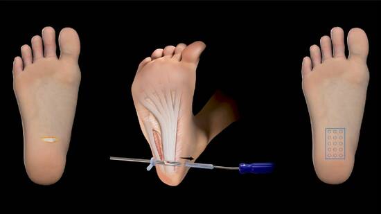 Plantar Fasciitis: General Surgical Considerations : OrthoPedia