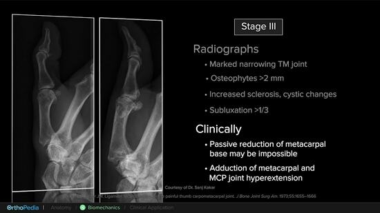 Biomechanics of Thumb CMC Arthritis : OrthoPedia