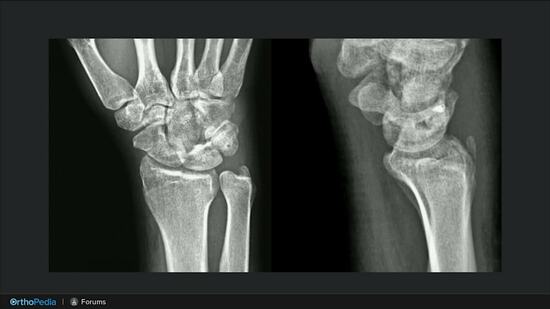 Cracking the Myth of Lunotriquetral and ECU Tears: Part 5 ...