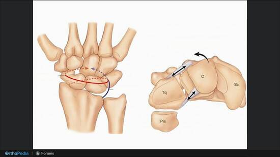 Hand, Wrist, and Elbow OTIF: Midcarpal Instability : OrthoPedia