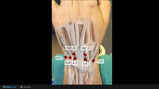 Hand, Wrist, and Elbow OTIF: Radiocarpal and Midcarpal Arthroscopy ...