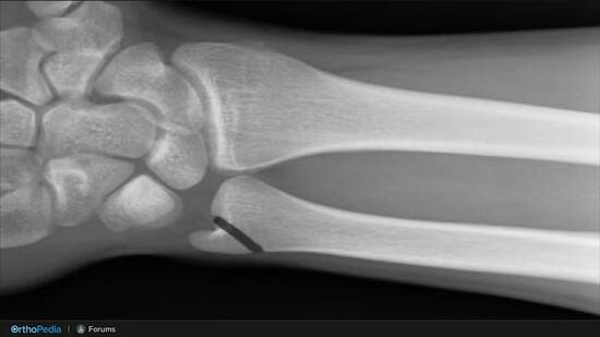 Hand, Wrist, and Elbow OTIF: TFCC Tears : OrthoPedia