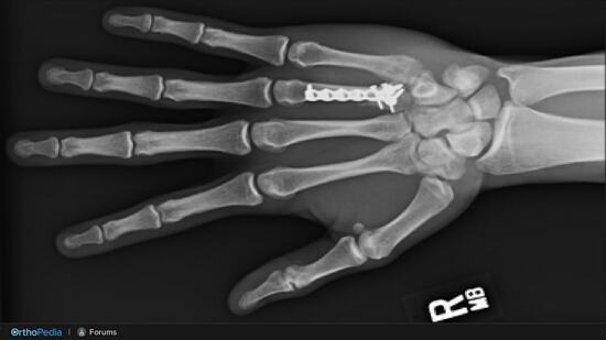 Hand, Wrist, and Elbow OTIF: Thumb CMC Dislocations : OrthoPedia