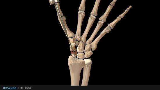 NanoScope™ Operative Arthroscopy System and Minimally Invasive Hand ...