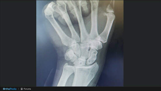 NanoScope™ Operative Arthroscopy System and Minimally Invasive Hand ...