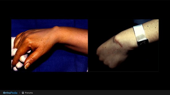 NanoScope™ Visualization System and Minimally Invasive Hand, Wrist, and ...