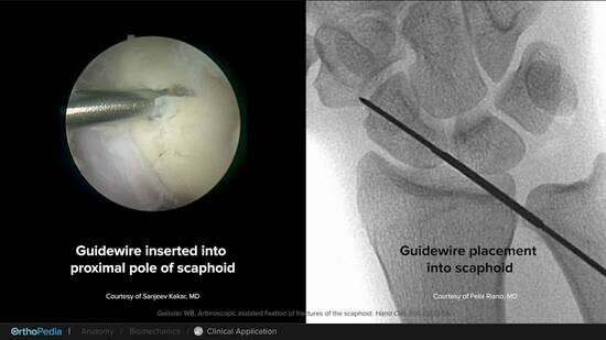 Scaphoid Fractures: Arthroscopic Assisted Fixation of Scaphoid ...
