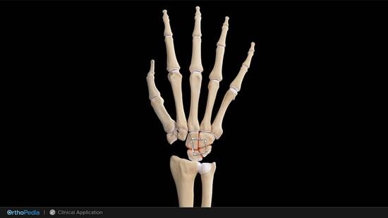 Scapholunate Ligament Injury: Salvage Procedures—DynaNite® Staples for ...