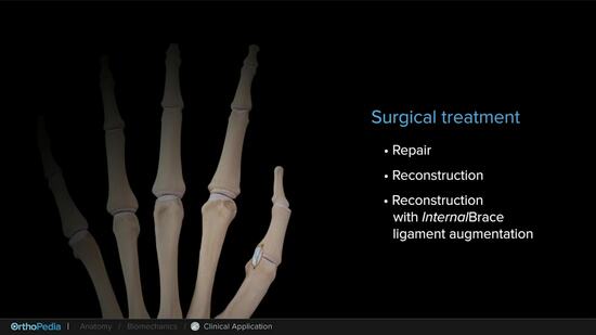 Thumb Ulnar Collateral Ligament Injuries: General Surgical ...