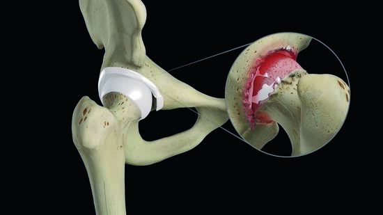 Biomechanics of the Hip With Arthritis : OrthoPedia