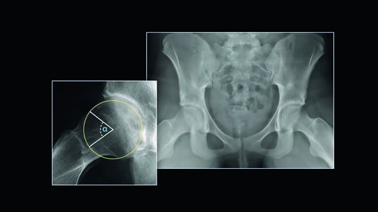 Biomechanics of the Hip With Femoroacetabular Impingement : OrthoPedia