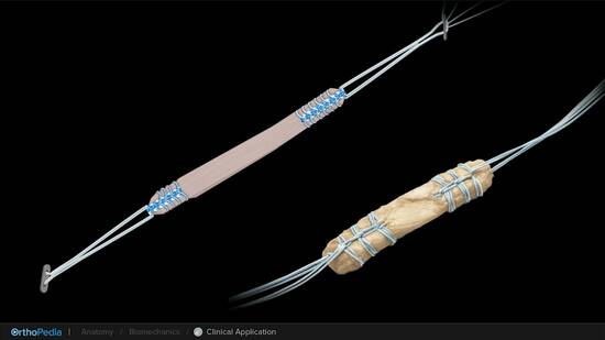 ACL Injuries: Arthroscopic All-Inside ACL Reconstruction Using the ...