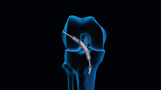 ACL Injuries: Literature Review on the Use of Quadriceps Tendon ...