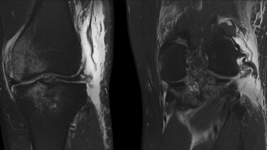 Biomechanics of the Knee With Collateral Ligament Injuries: Lateral ...