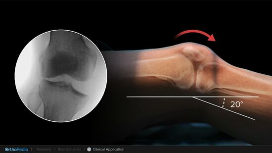 Collateral Ligament Injuries: General Surgical Considerations for MCL ...