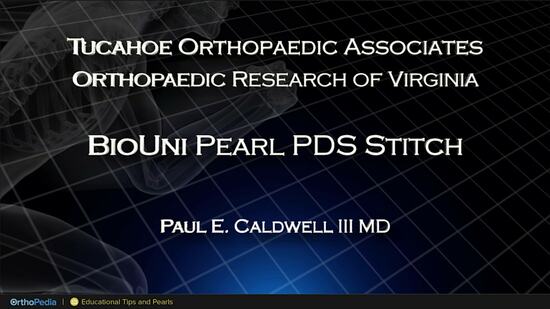 Dr. Caldwell Demonstrates Tips and Pearls for Osteochondral Defects ...