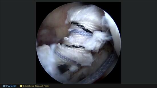 Dr. DiFelice Demonstrates Tips and Pearls for ACL Tears: Stuff the ACL ...