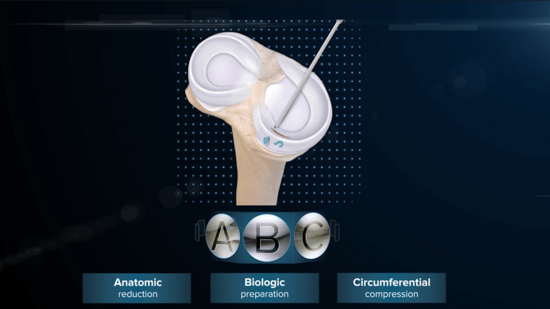 FiberStitch™ Implant Biomechanical Research for Knee Meniscal Repair ...