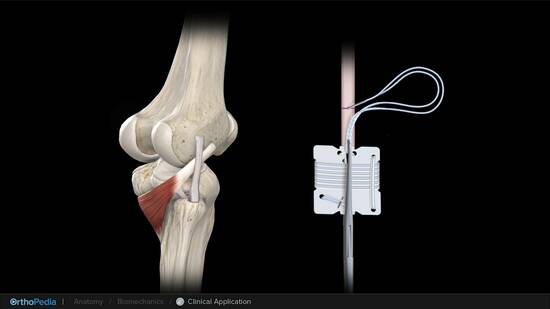 Knee Collateral Ligament Injury: Posterolateral Corner (PLC ...