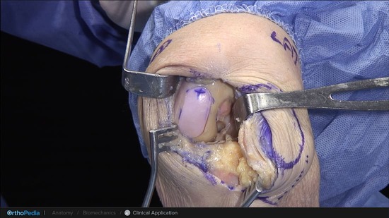 Osteochondral Lesions: Allograft BioUni® OATS® Procedure for Condylar Defects : OrthoPedia