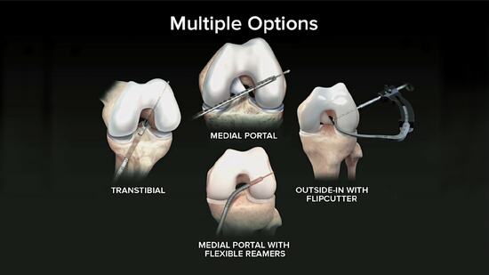 Sports Medicine Fellowship Forum: ACL Reconstruction—Options for ...