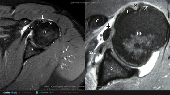 Biomechanics of the Shoulder With Subscapularis Tears : OrthoPedia