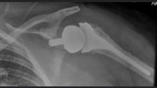 Dr. Werner Demonstrates Tips and Pearls for Glenohumeral Joint ...