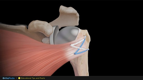 Dr. Werner Demonstrates Tips and Pearls for Glenohumeral Joint ...