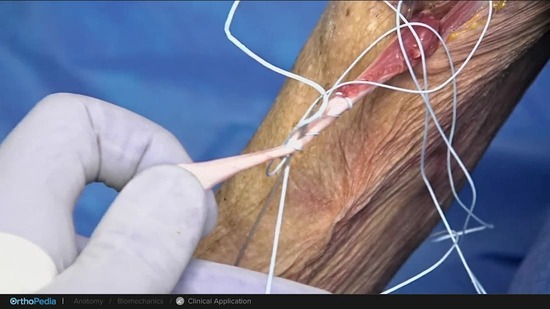 Proximal Biceps Tendinopathy Open Subpectoral Tenodesis With Unicortical Proximal Tenodesis