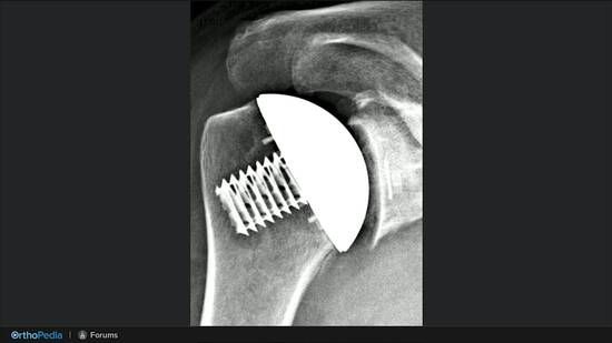 Shoulder Summit: Innovations in Anatomic Total Shoulder Arthroplasty ...
