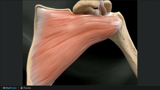 Shoulder Summit: Maximizing Exposure and Subscapularis Management in ...