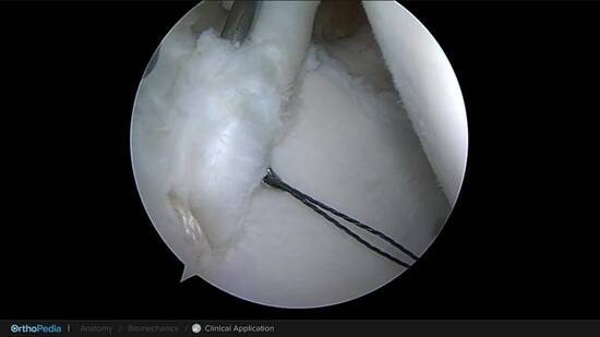 SLAP Tears: Knotless Repair With PushLock® Anchors and LabralTape ...