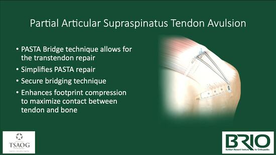 Sports Medicine Fellowship Forum: PASTA Lesions—Fixation and Biologic ...