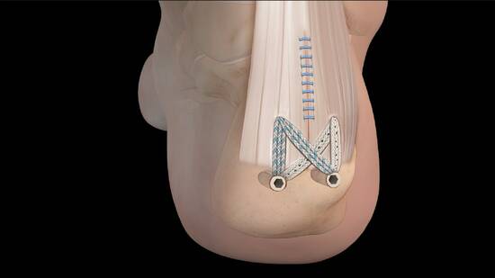 Achilles Tendon Pathology: General Surgical Considerations of ...
