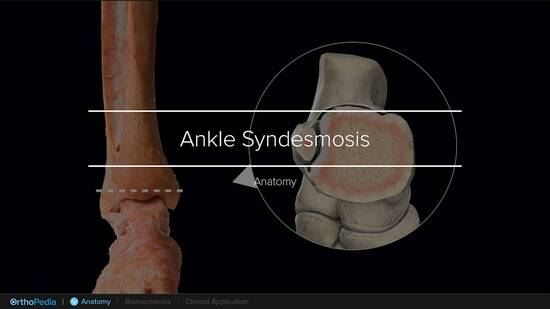Anatomy of the Ankle With a Syndesmosis Injury : OrthoPedia