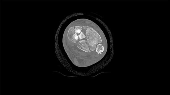 Anatomy of the Ankle With Pilon Fractures : OrthoPedia