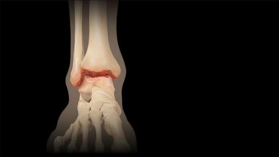 Anatomy of the Hindfoot With Ankle Arthritis : OrthoPedia