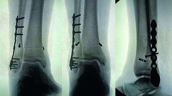 Ankle Fractures and Syndesmosis Injuries: Literature Review in Support ...