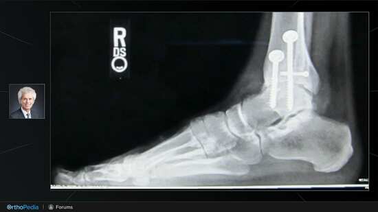 Ankle Fusion in 2020: Part 3—Anterior Plate Ankle Arthrodesis: Surgical ...