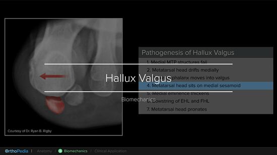 Biomechanics of a Foot With Hallux Valgus Deformity : OrthoPedia