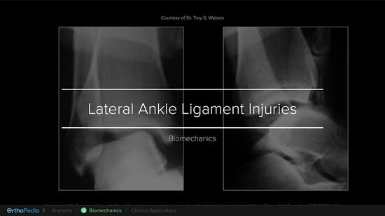 Biomechanics of the Foot and Ankle With Lateral Ankle Instability ...