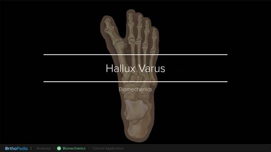 Biomechanics of the Foot With Hallux Varus Deformity : OrthoPedia
