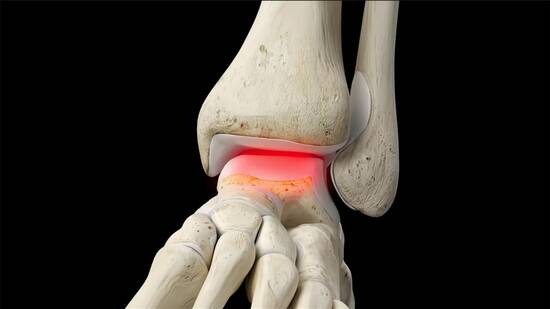 Biomechanics of the Hindfoot and Ankle With Arthritis : OrthoPedia